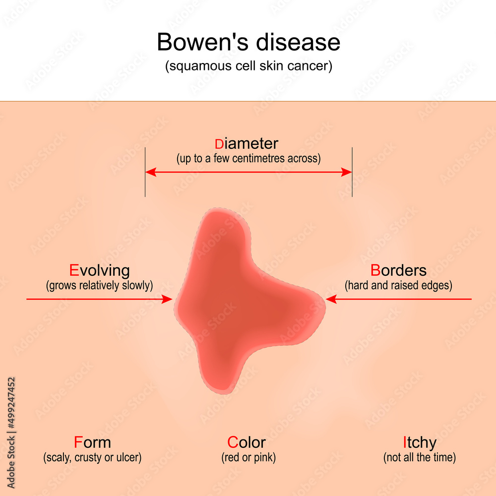 Bowen's disease. squamous cell skin cancer. Stock Vector | Adobe Stock