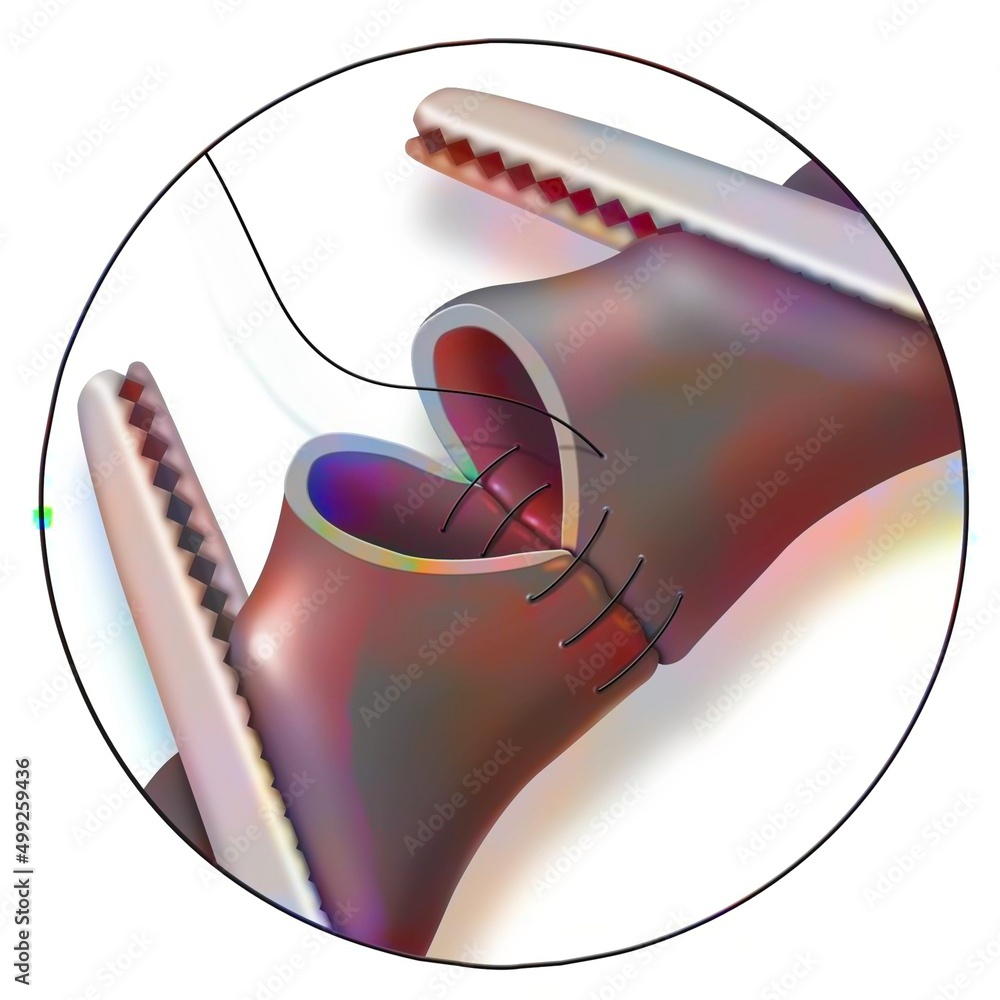 Poster Blood vessels: suture between two arteries during a transplant ...