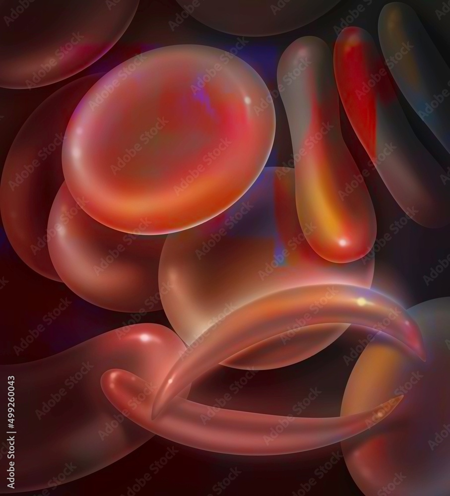 Normal red blood cells and sickle cells (sickle shaped red blood. Stock ...