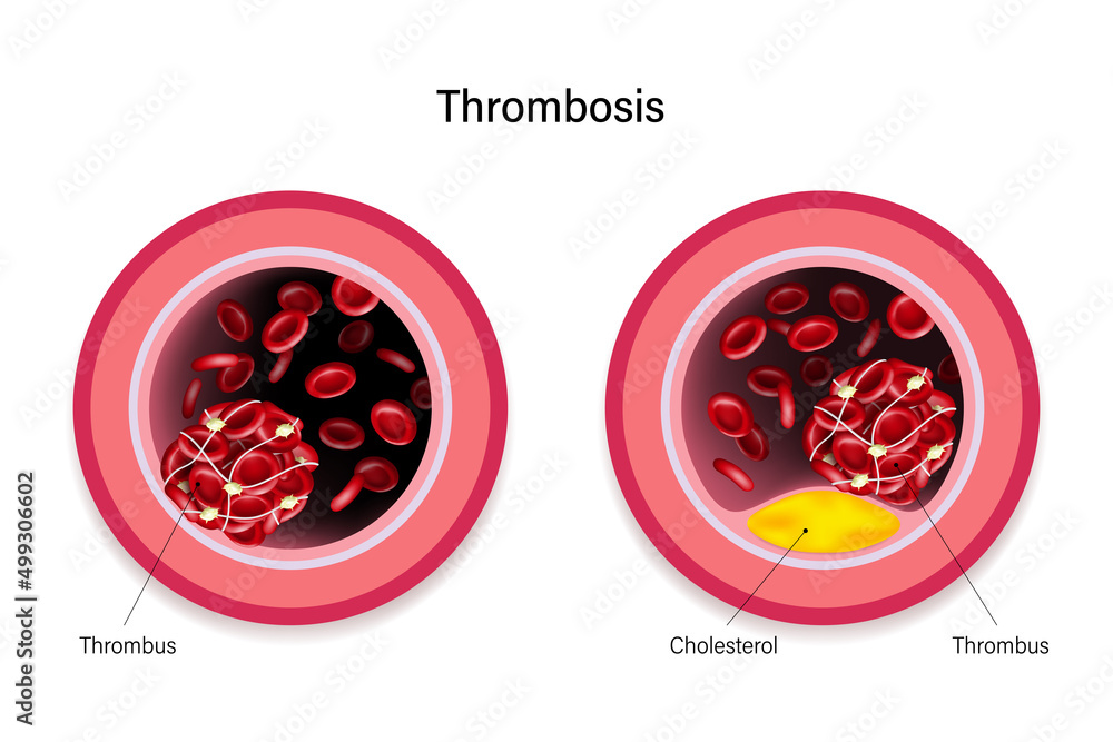 Thrombosis in blood vessel. Blood clots or thrombus block the flow of blood. vector de Stock ...