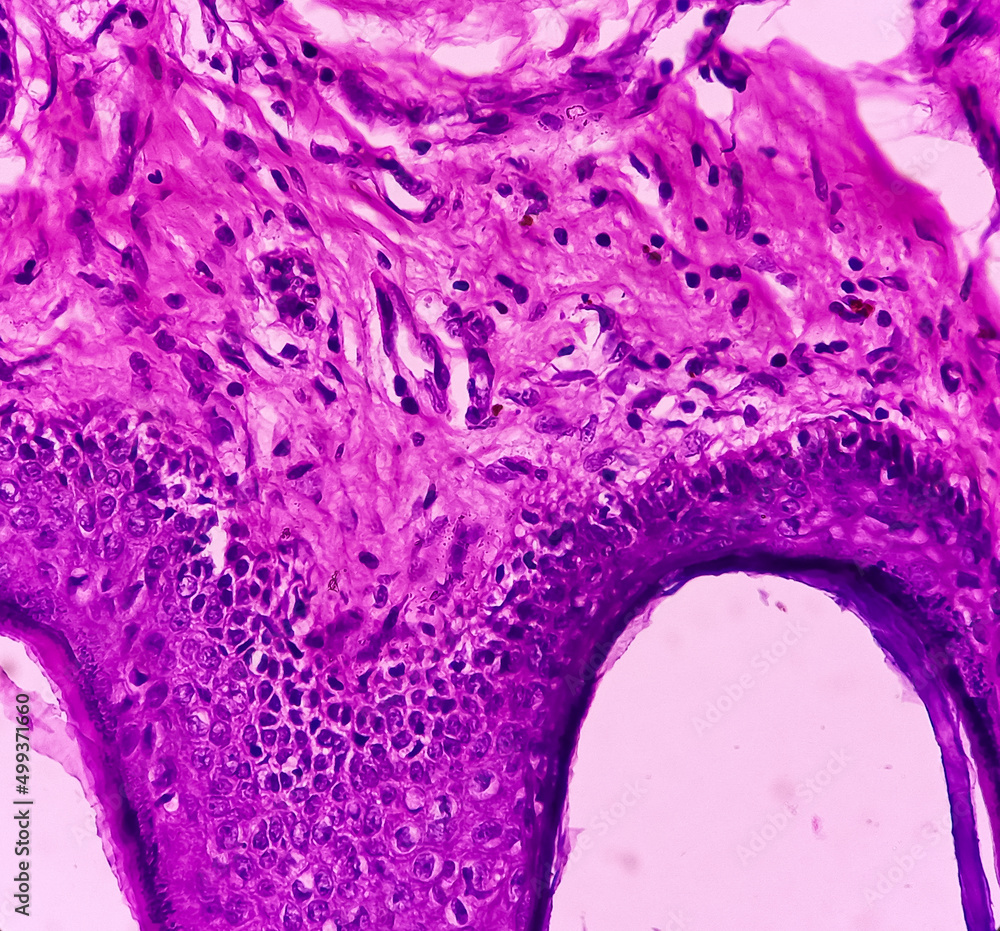 Ovarian cyst: Cystic teratoma, microscopic show skin, adenexal ...