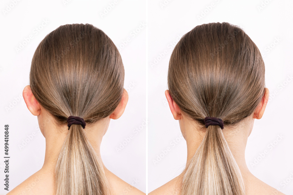 Rear view of a woman's head with ears before and after otoplasty ...