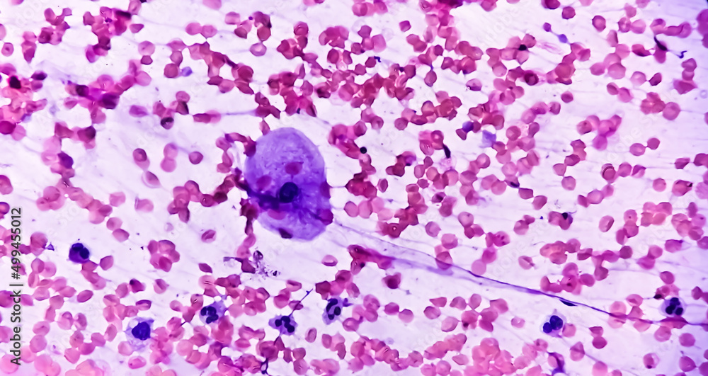 Foto de Microscopic view of vault smear showing radiation induced ...