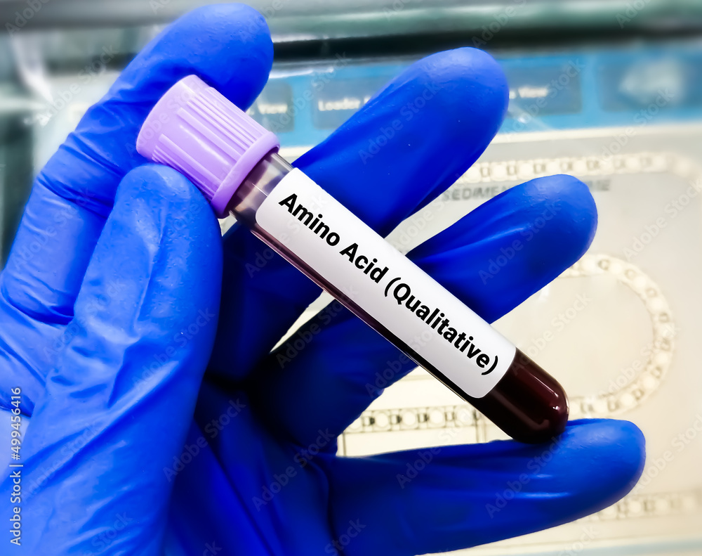 Blood sample for amino acid (Qualitative) test in PCR laboratory. Stock ...