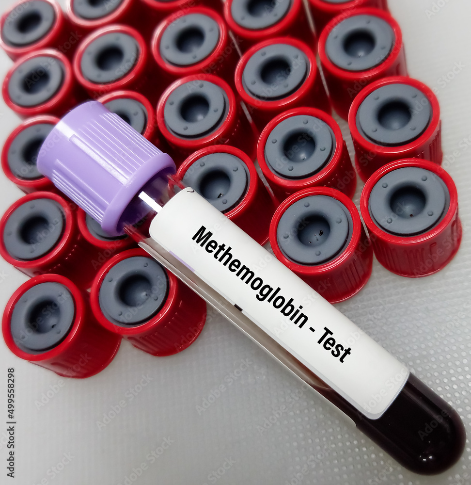 Blood sample for Methemoglobin test with colorful test tube top ...