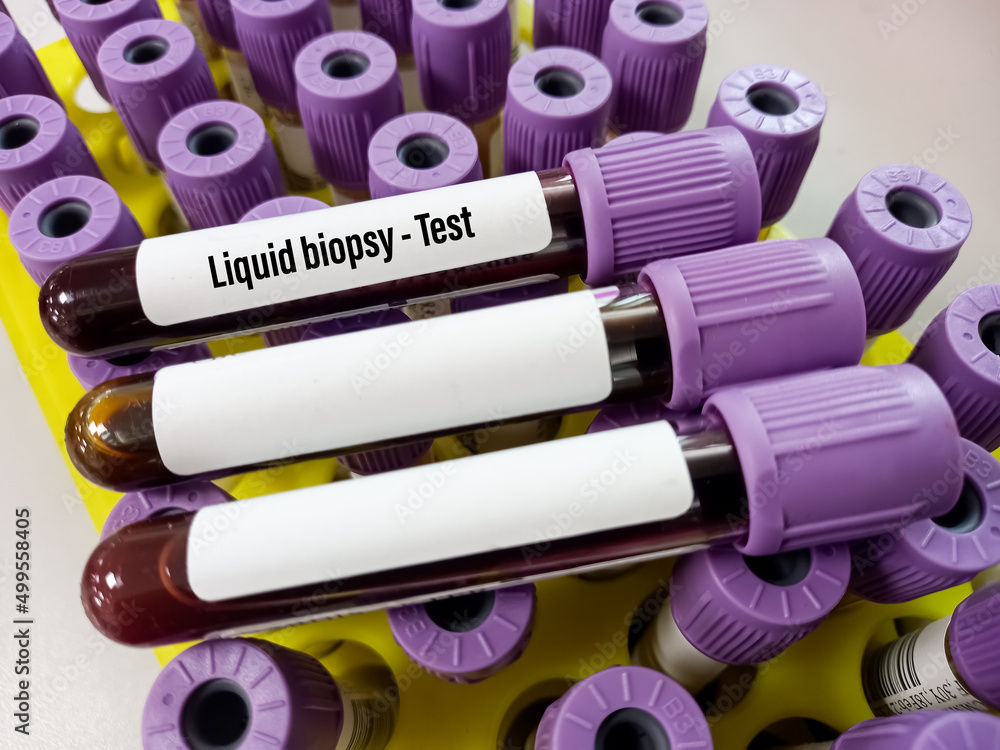 Blood samples for Liquid biopsy blood test to detect cancer cells or ...