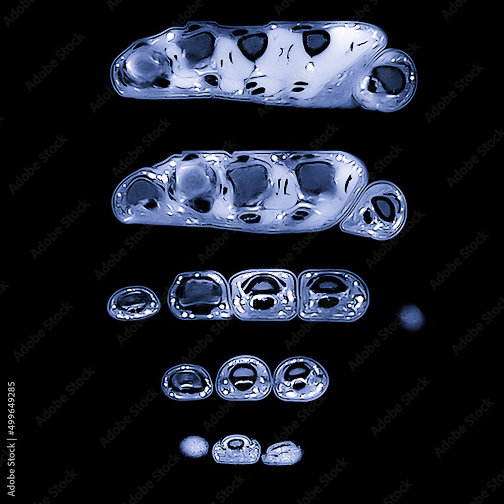 X-ray MRI image of fingers and hand, cross section at various stages of ...