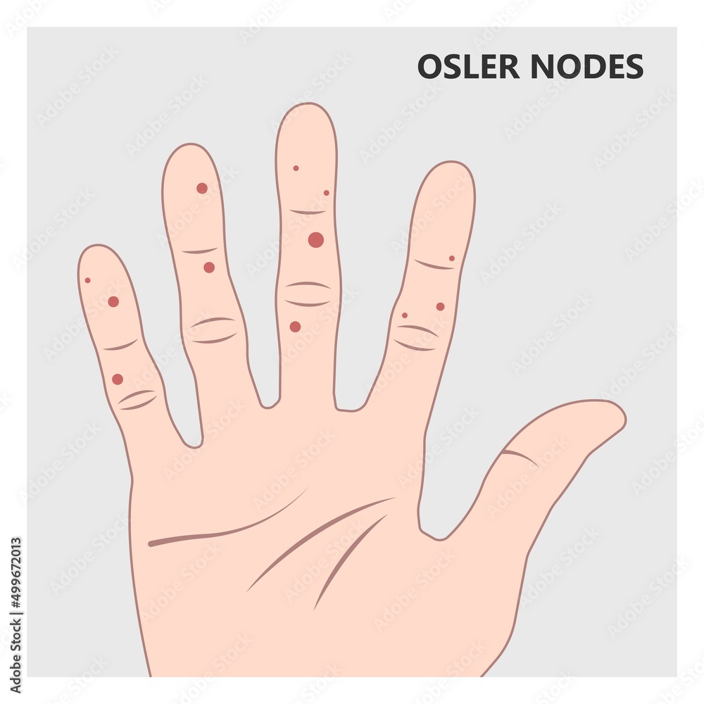 Plakat Acute aortic mitral valve bacteria fungi germs fever gum sepsis ...