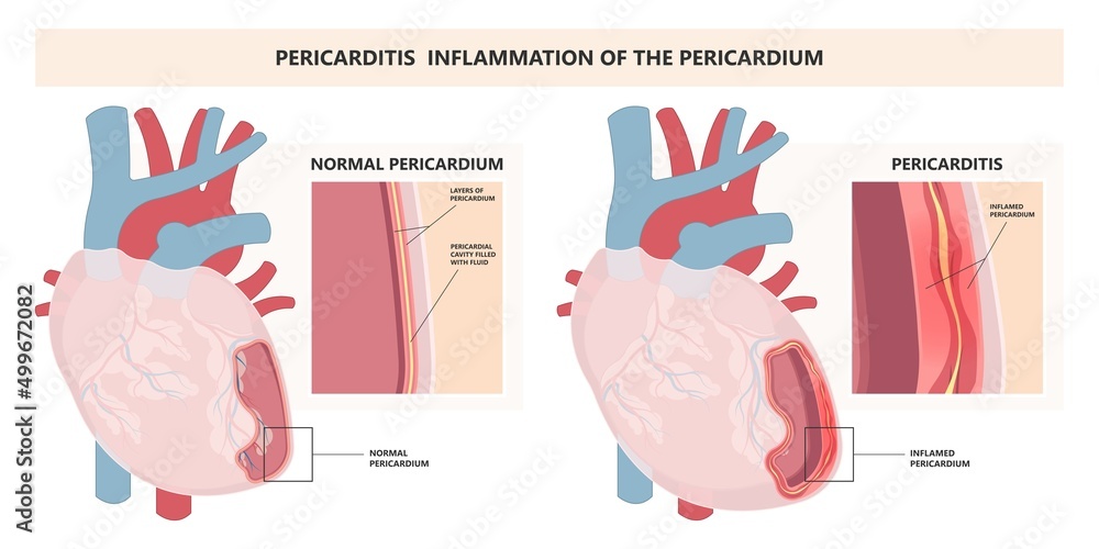 Heart attack acute chest pain injury difficulty breathing fat pads ...