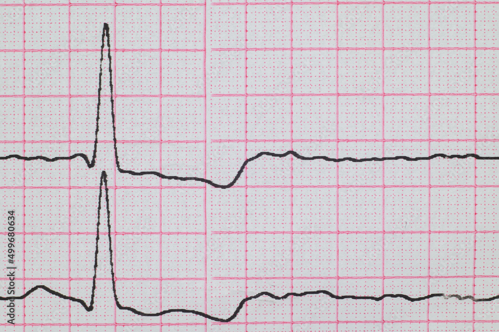 ECG. Myocardial ischemia on ECG.Angina.Chest pain. Close-up. ภาพถ่าย ...
