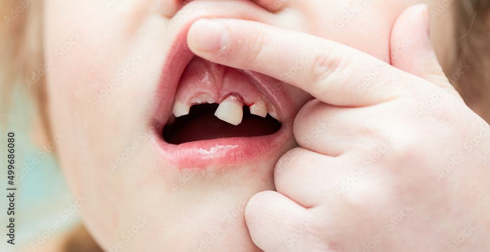 A little girl lost her baby milk tooth. Lost temporary tooth. The ...