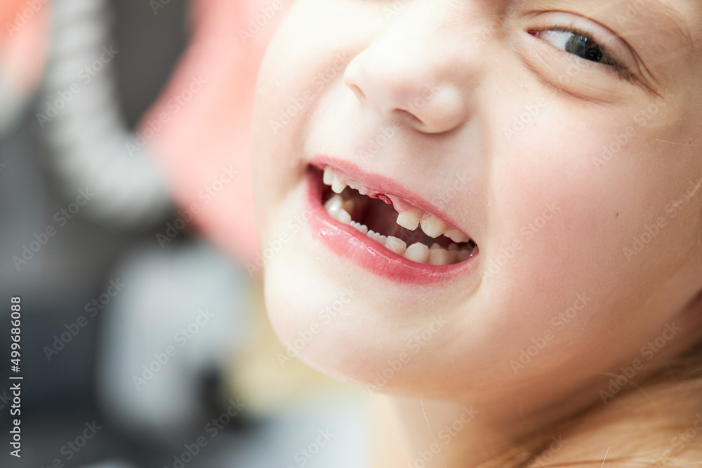 A little girl lost her baby milk tooth. Lost temporary tooth. The ...