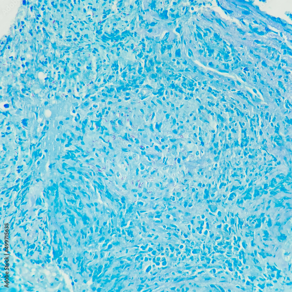 Camera photo of tuberculosis in abdominal lymph node, showing positive ...