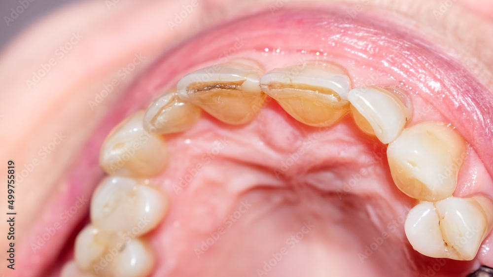 Close-up of a worn and fractured dentition of an elderly lady. Upper ...