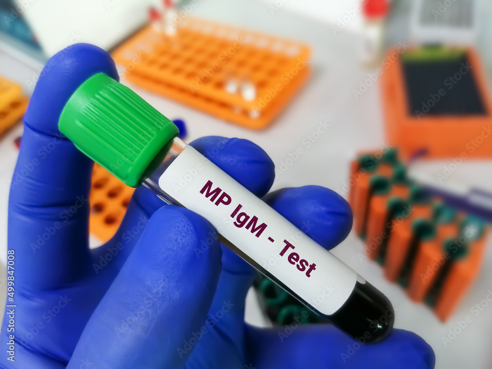 Blood sample for Mycoplasma pneumoniae IgM or MP IgM test. Stock Photo ...