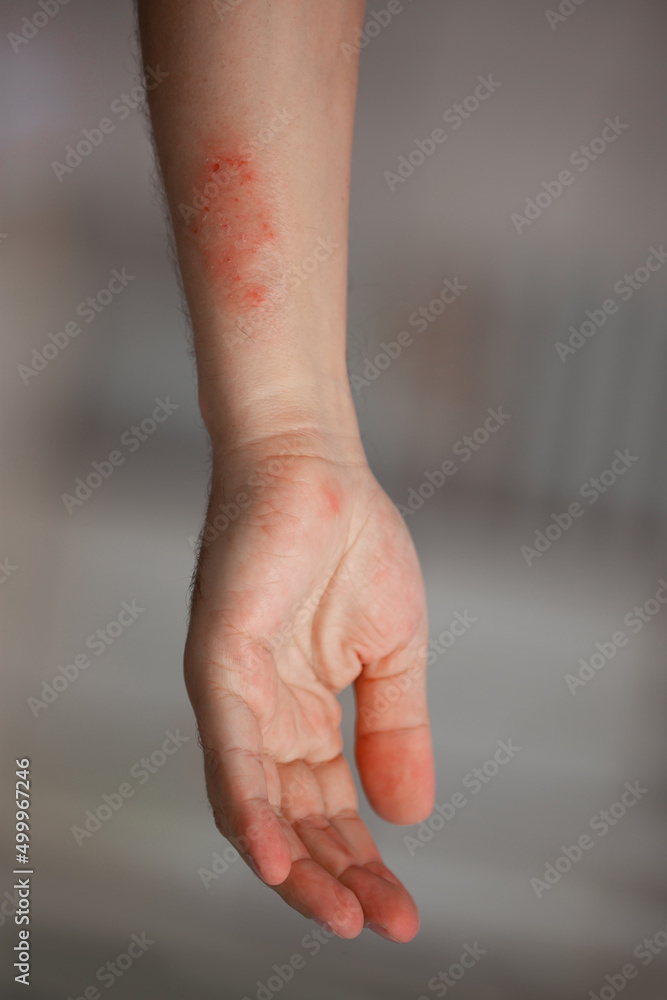 Spots, sores on human skin. Infection rash, psoriasis, eczema, lichen ...