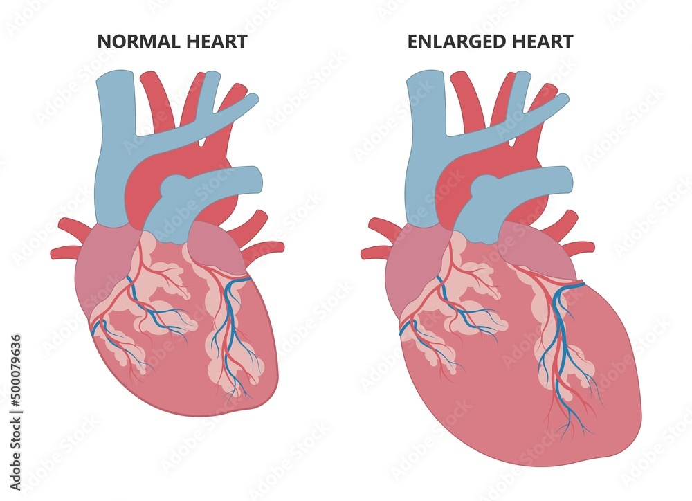 Enlarged athlete's heart angina x-ray edema test diagnose chest pain ...