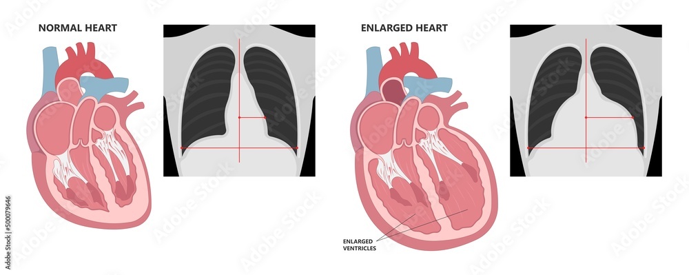 Enlarged athlete's heart angina x-ray edema test diagnose chest pain ...