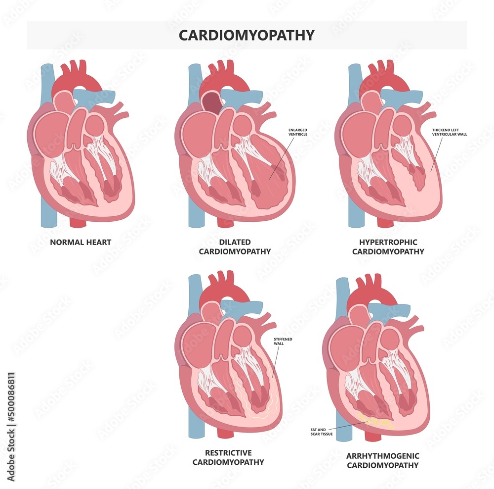 Cardiomyopathy Heart attack artery hypertrophy chamber stress stiff ...
