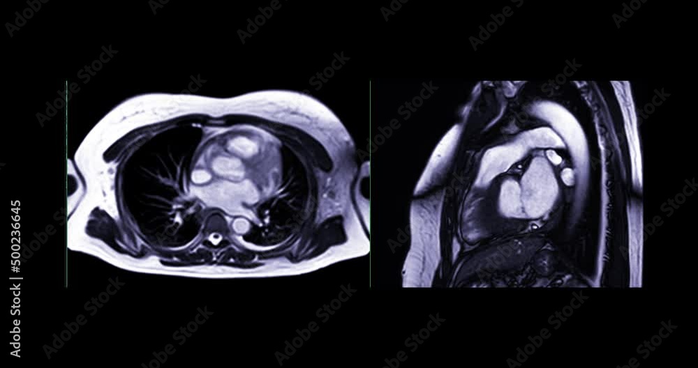 MRI heart or Cardiac MRI ( magnetic resonance imaging of heart ...