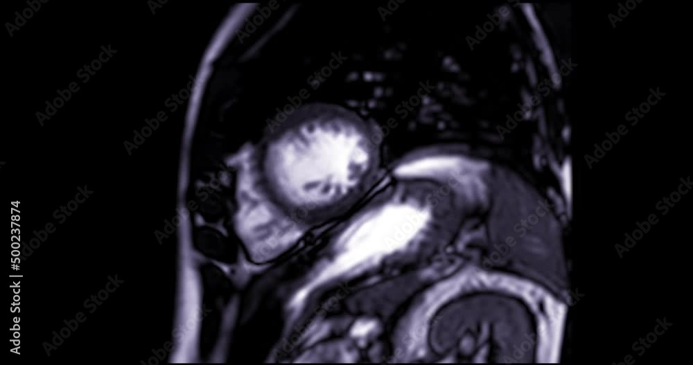 MRI heart or Cardiac MRI ( magnetic resonance imaging of heart ...