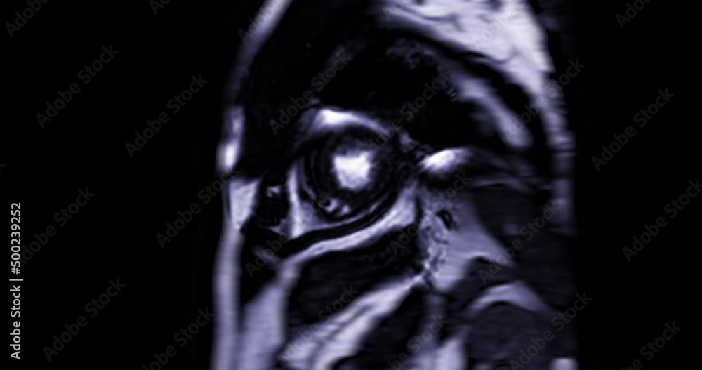 MRI heart or Cardiac MRI ( magnetic resonance imaging of heart ...