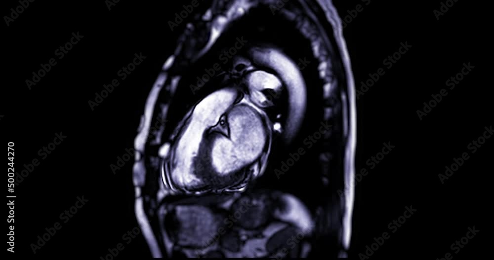 MRI heart or Cardiac MRI ( magnetic resonance imaging of heart ...