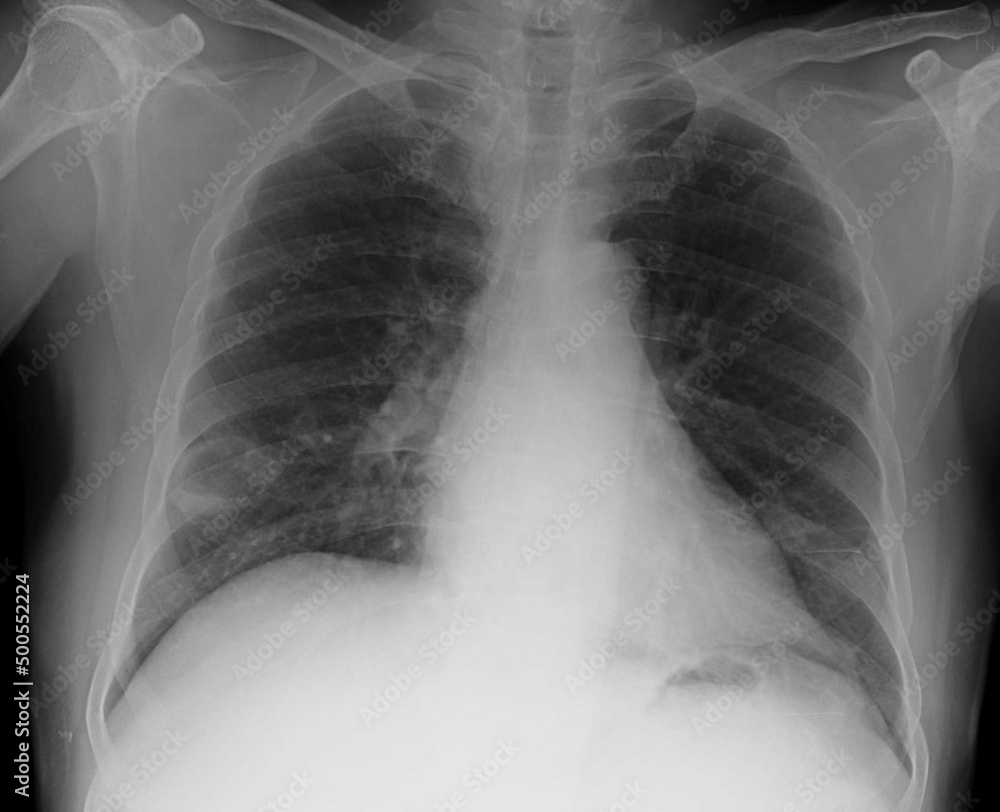 chest x-ray image of lung abscess Stock Photo | Adobe Stock