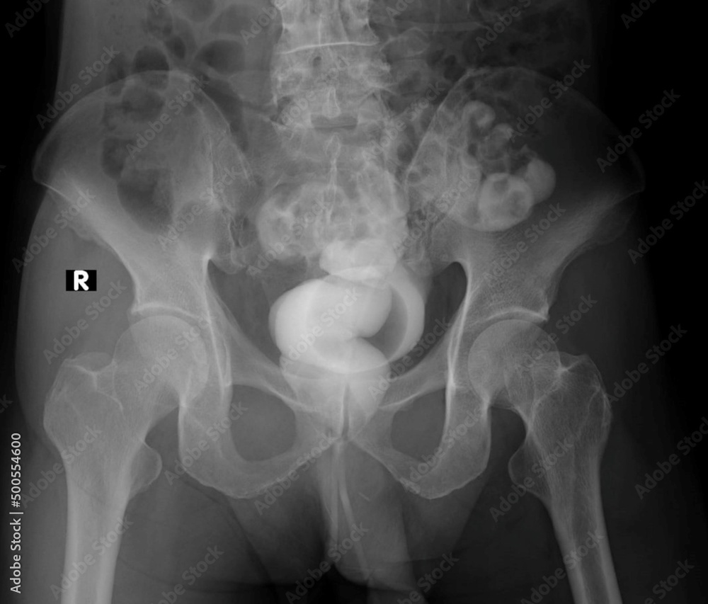 X-ray image of rectovesical fistula A barium enema contrast study ...