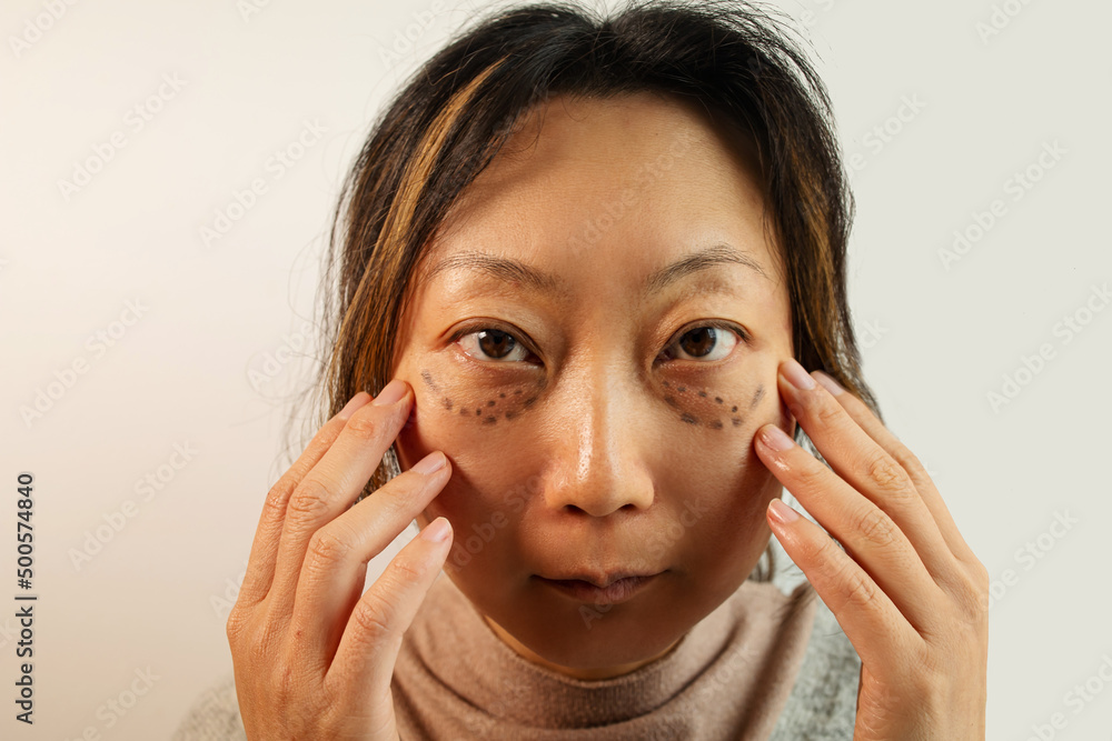Asian Woman With Under Eye Bag Puffy Eye Of Girl Showing Eyes Bags Before And After Cosmetic