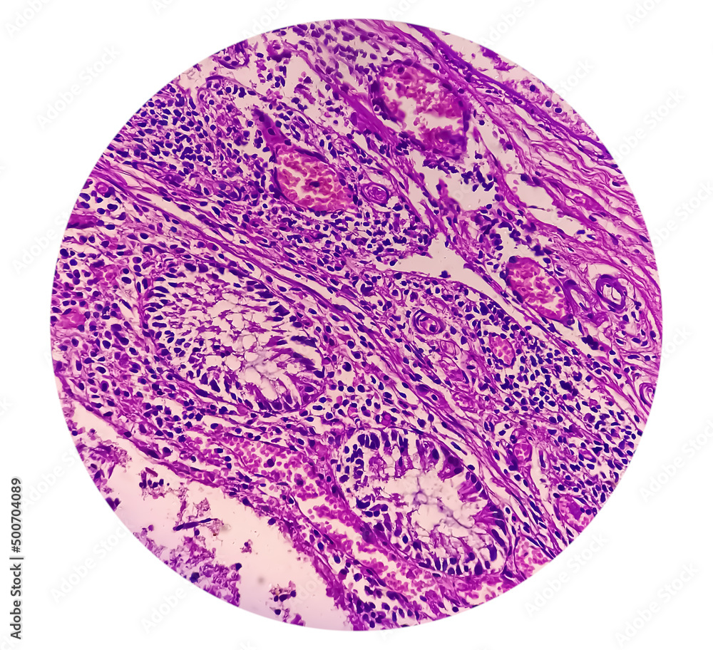 Microscopic image (photomicrograph) of a cross section of an appendix ...
