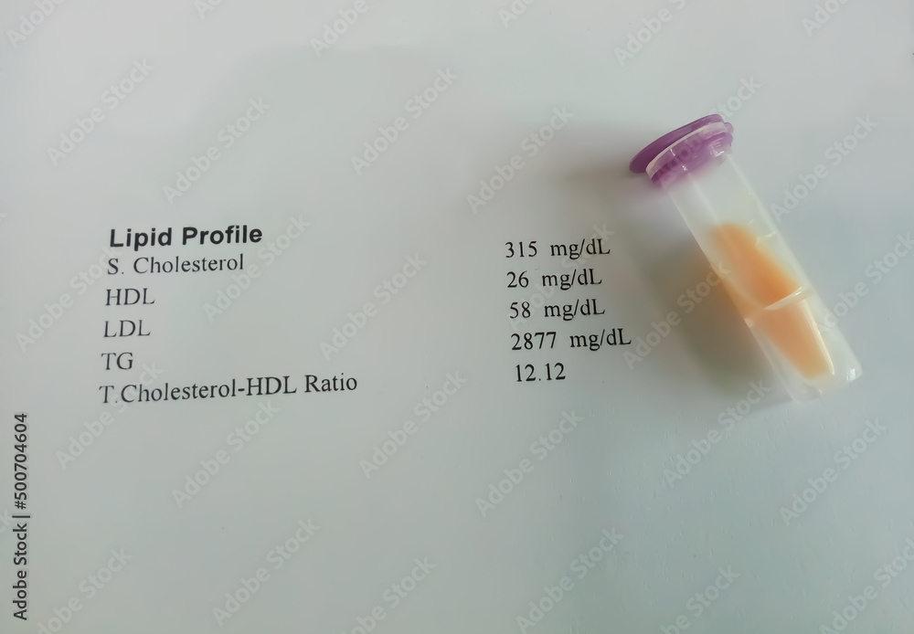 Abnormal Lipid profile report with Lipemic serum sample isolated ...