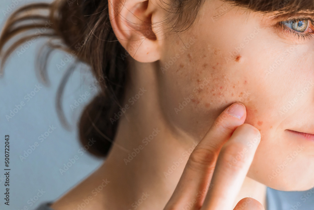 Beautiful girl with acne problem on her face skin, clean blurred ...