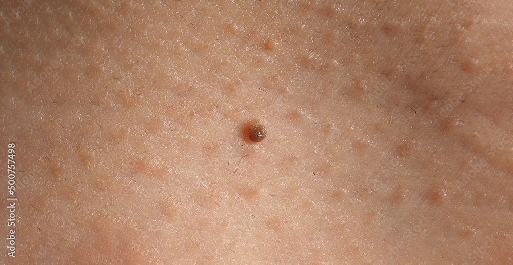 Wart skin removal. Macro shot of warts near eye on face. Papilloma on ...