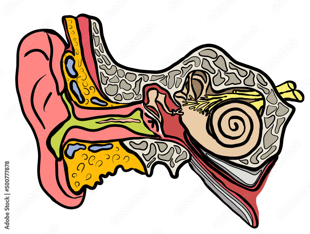 Abbildung einer Otitis externa erysipel. Entzündung des Gehörgangs mit ...