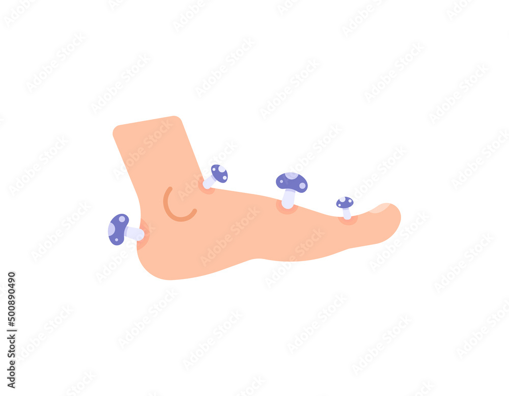 Vetor de illustration of foot overgrown or infected by fungus. fungal ...