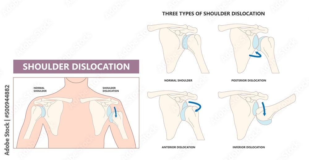 Shoulder dislocation X-ray joint arm sport lesion slap hill sachs tear ...