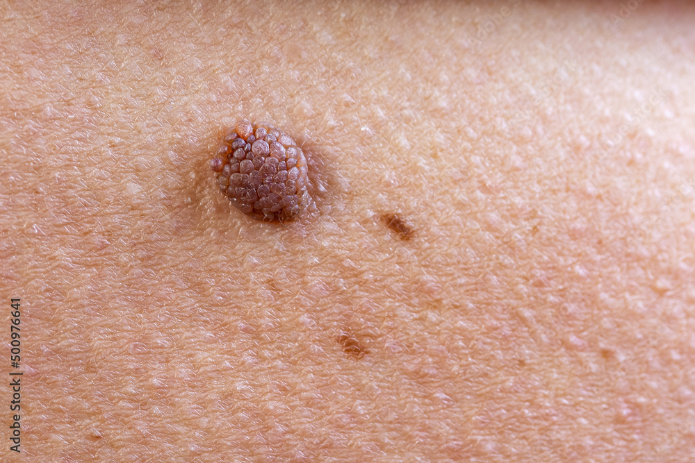 Oncology mole big wart on old woman. Concept dermatology skin cancer ...