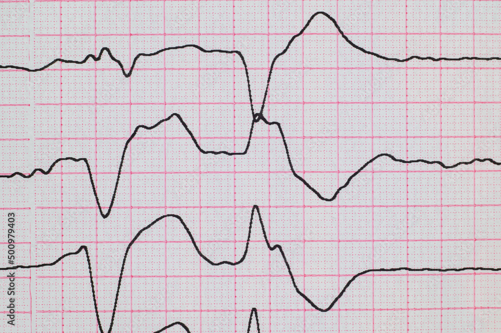 ECG with rhythm disturbance and ventricular extrasystole close-up Stock ...