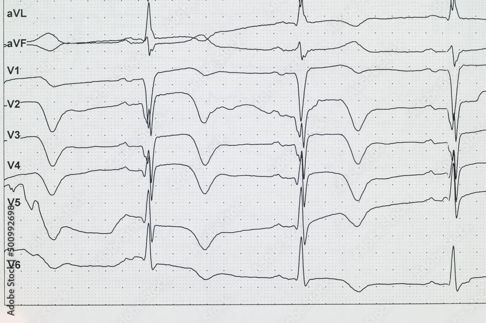 ECG. Myocardial infarctionon ECG. Angina.Chest pain. Close-up. Stock ...