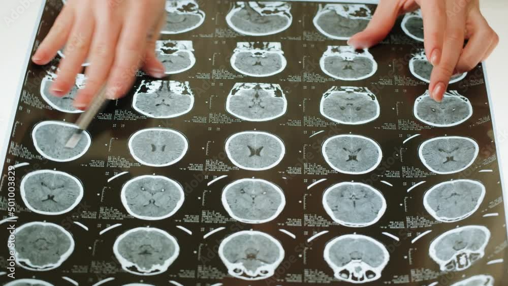 X-ray, Magnetic resonance image of head, human brain MRI close-up ...