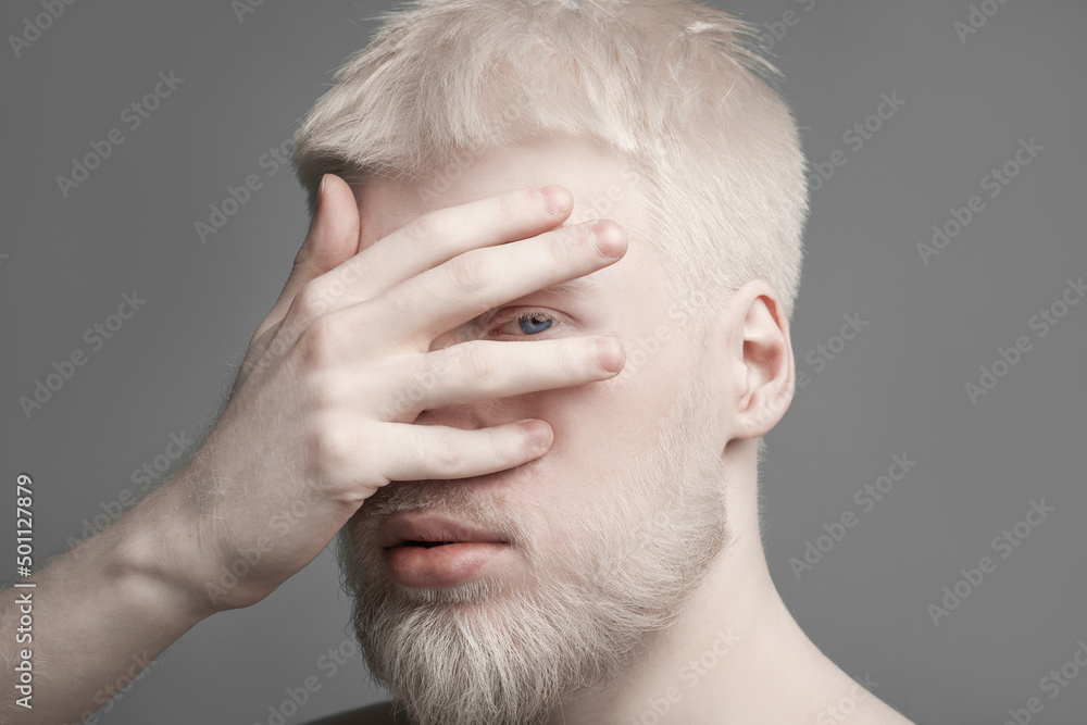 Uncommon albino guy closing his face with palm, looking with one eye ...