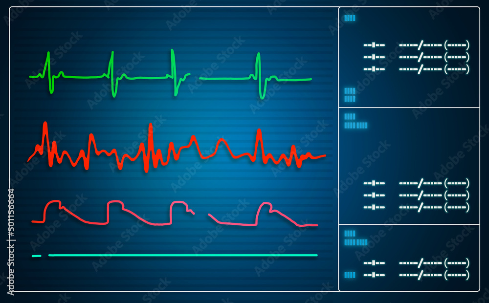 Patient monitor showing vital signs ECG and EKG. Stock Illustration ...