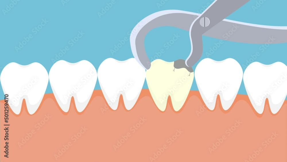 Tooth getting cavities and cracking down 4K animation. Dentist pulling ...