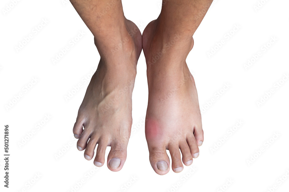 Comparison of normal men's feet with swollen sides red because it's ...
