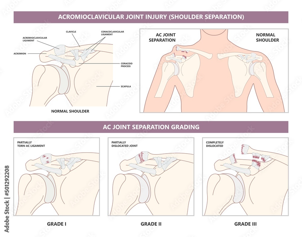 Separation Dislocation The Ac Joint Fall Shoulder Bump Bruise Torn Cuff Tear Nerve Bone Broken