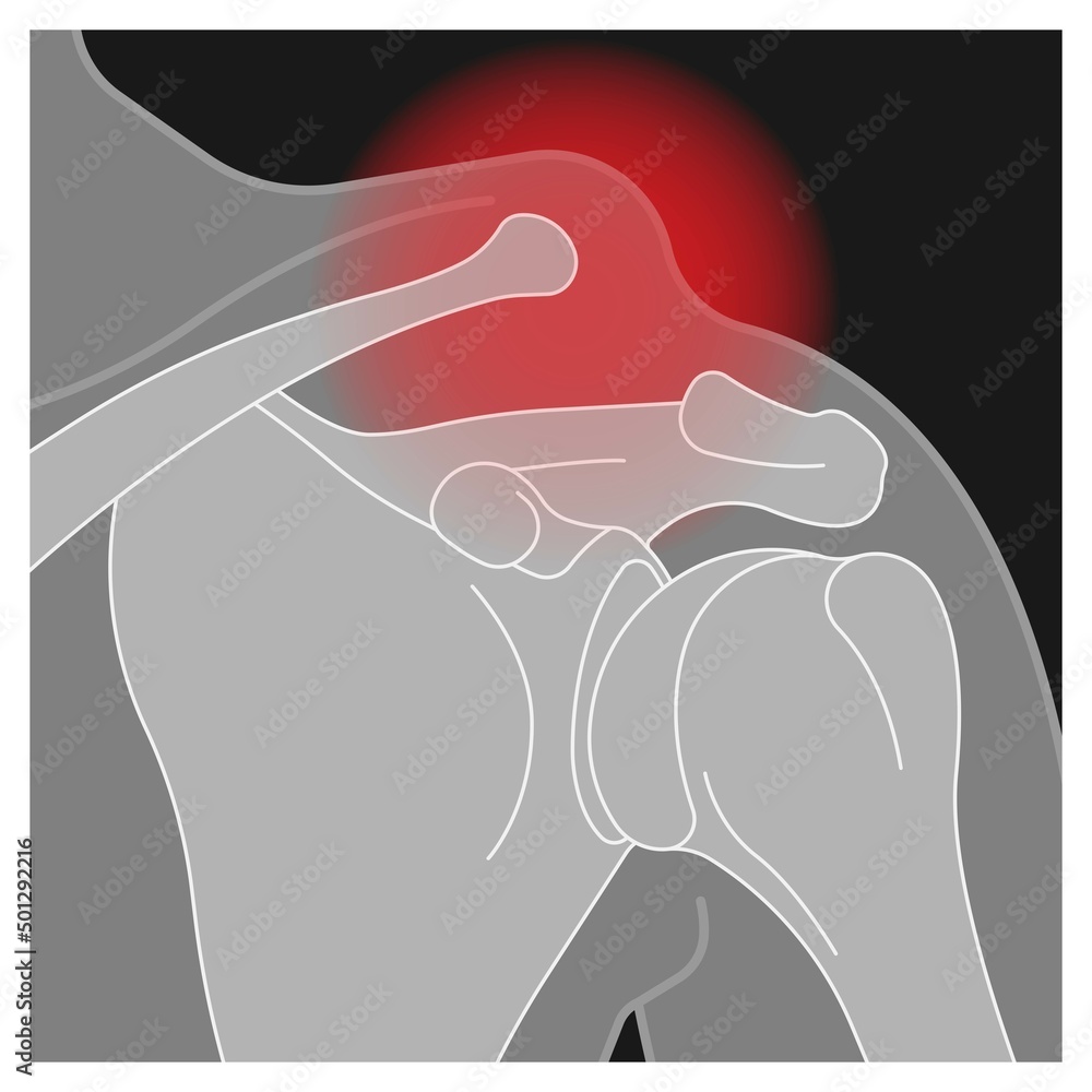 Separation Dislocation The Ac Joint Fall Shoulder Bump Bruise Torn Cuff Tear Nerve Bone Broken