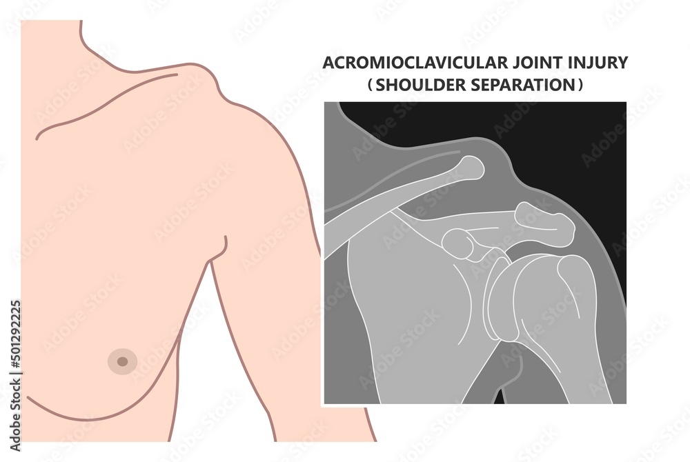Separation Dislocation The Ac Joint Fall Shoulder Bump Bruise Torn Cuff Tear Nerve Bone Broken