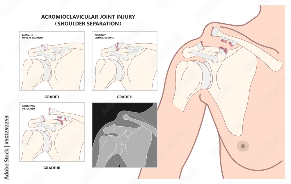 Separation Dislocation The Ac Joint Fall Shoulder Bump Bruise Torn Cuff Tear Nerve Bone Broken