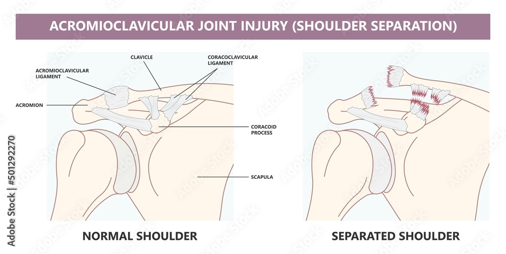 Separation Dislocation The Ac Joint Fall Shoulder Bump Bruise Torn Cuff Tear Nerve Bone Broken